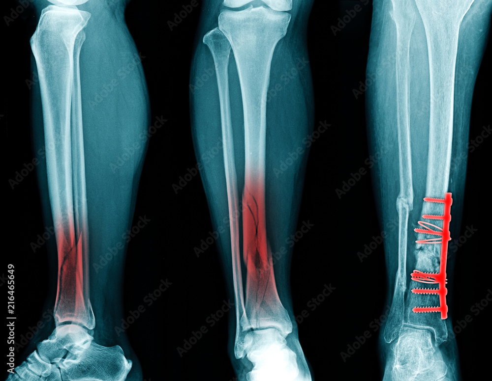 x-ray tibia and fibular fracture with post internal fixation Stock ...