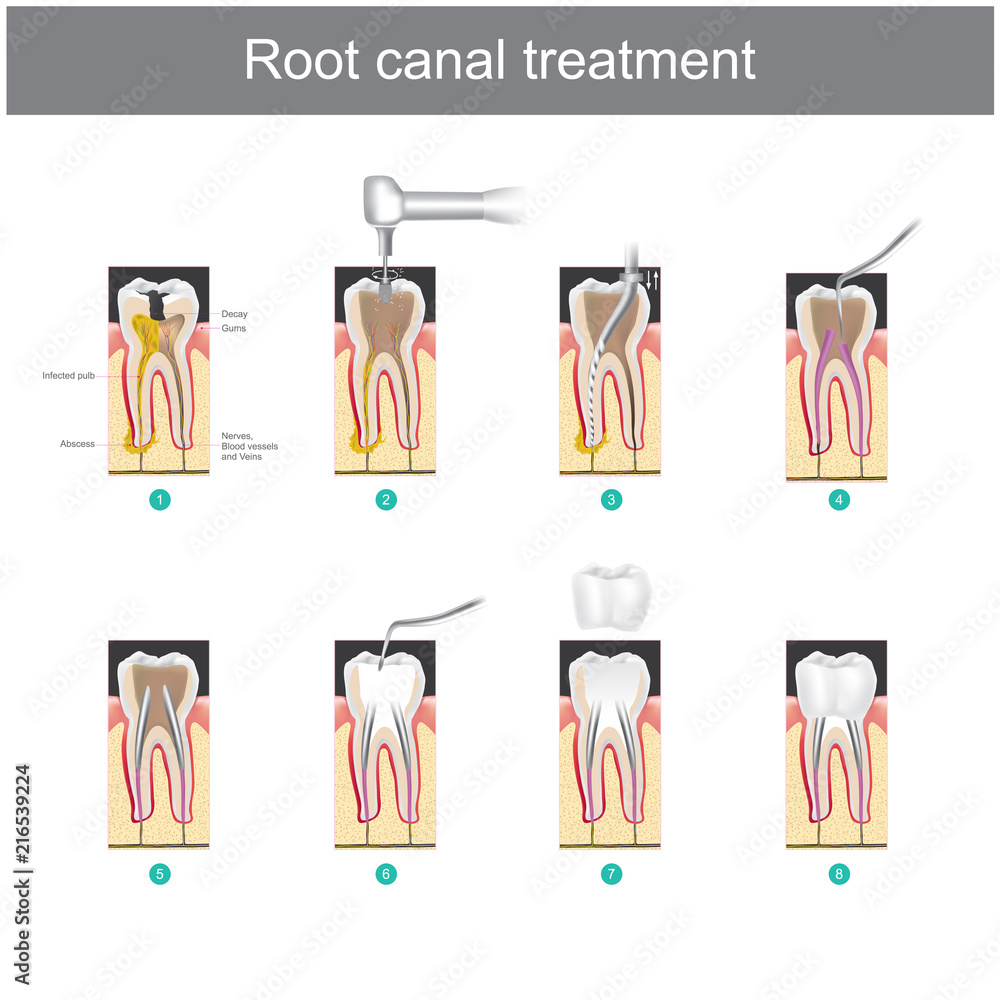 Root canal treatment. How to treat our teeth after the tooth is damaged ...