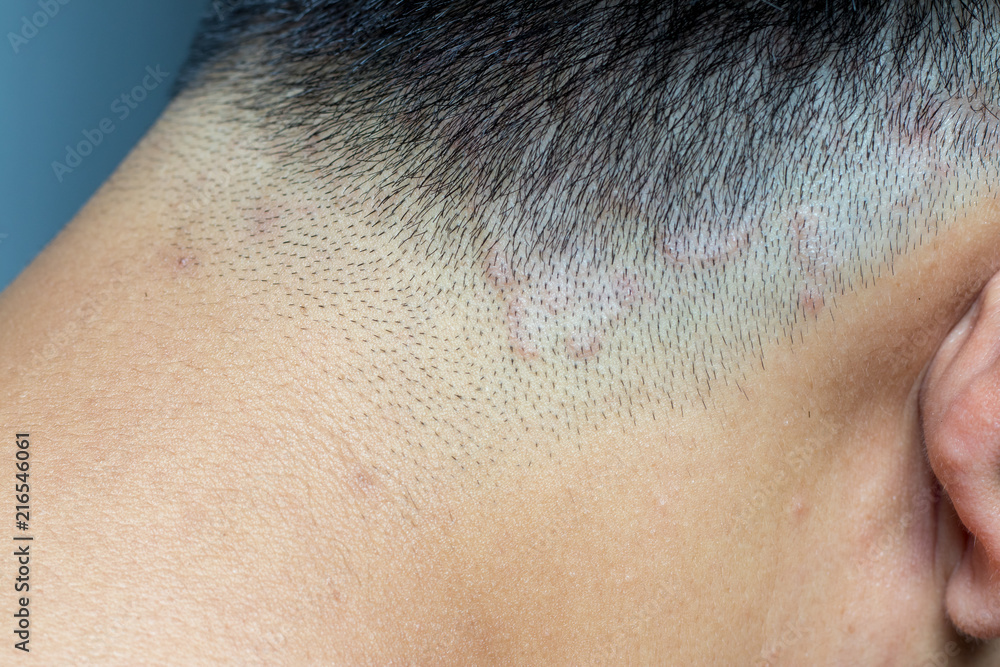 Closed up of ringworm (tinea) on head of asian man (Dermatitis) Stock ...