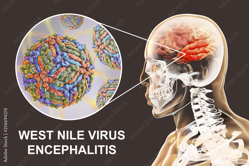 West Nile virus WNV encephalitis, 3D illustration showing brain ...