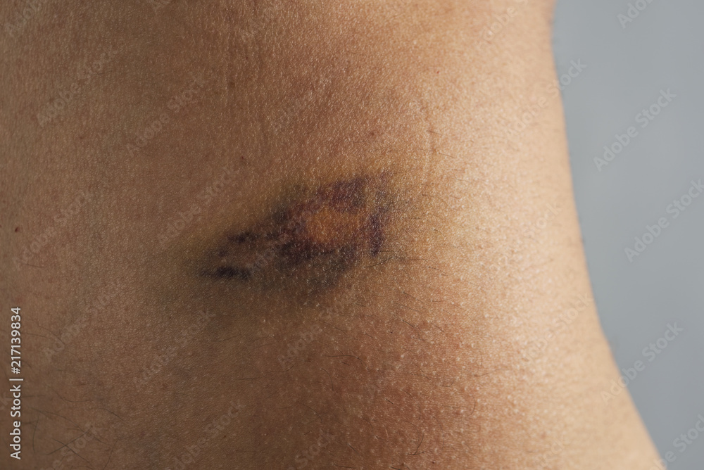 Left Flank Hematoma