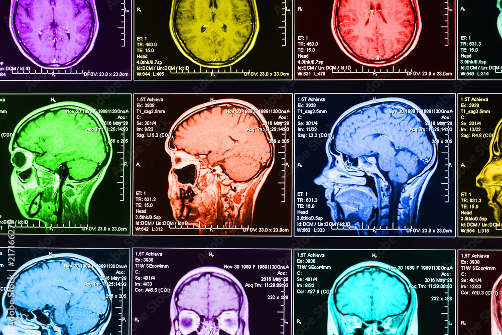 Magnetic resonance scan of the brain. MRI head scan Stock Photo | Adobe ...