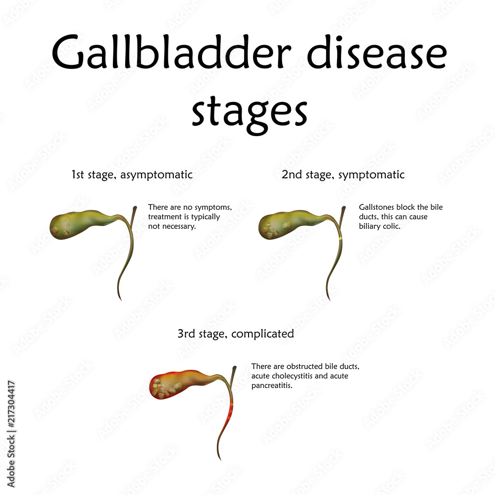 Gallbladder disease stages, inflammation. Gallstones. Cholecystitis ...