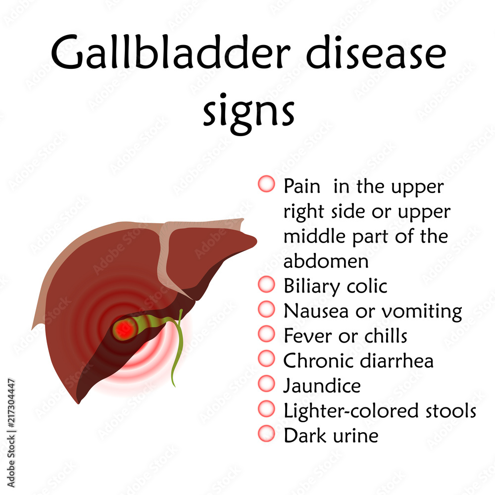 Vetor do Stock: Gallbladder disease signs, inflammation. Gallstones ...