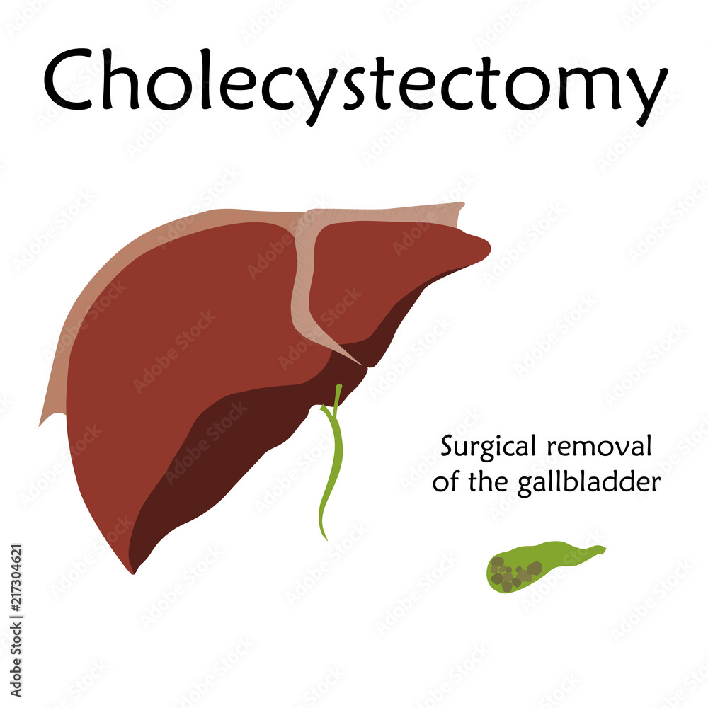 Gallbladder disease treatment, surgery, cholecystectomy, inflammation ...