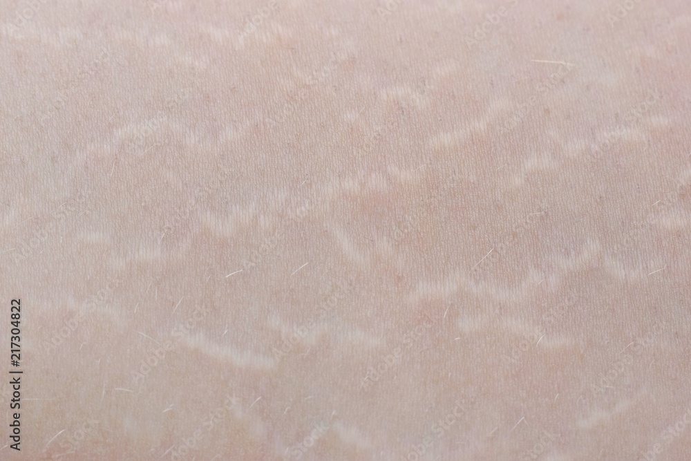 Striae -Detailed photography of stretch marks on human skin, cosmetic ...
