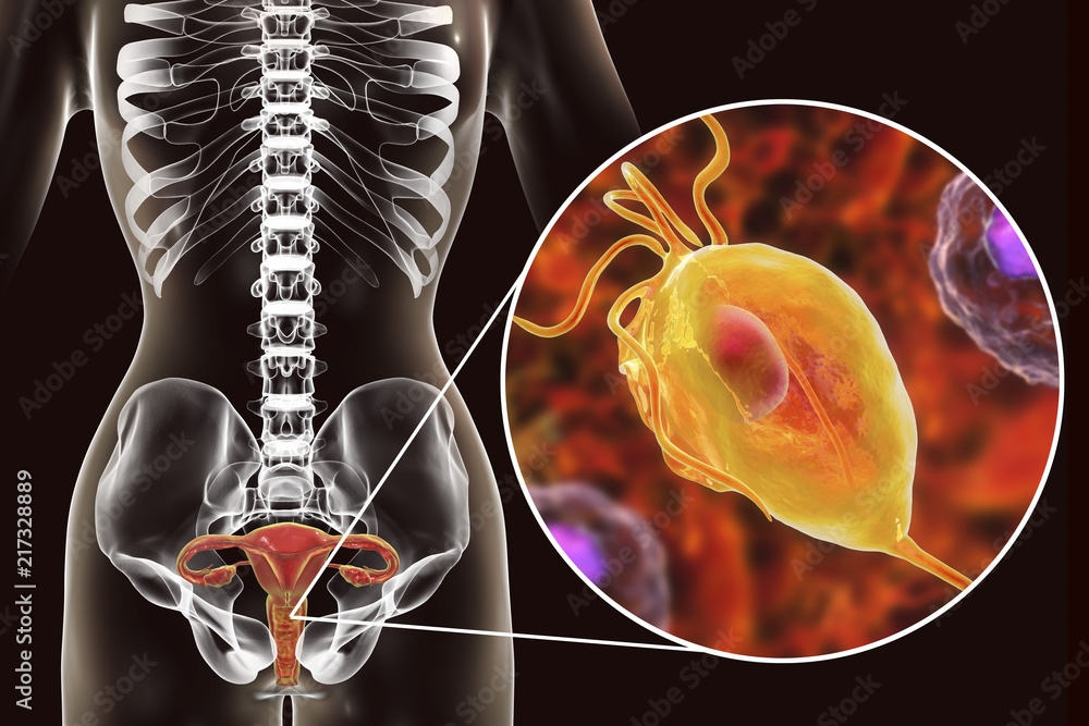 Female trichomoniasis, 3D illustration showing vaginitis and close-up ...