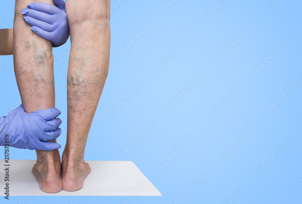 Lower limb vascular examination because suspect of venous insufficiency ...