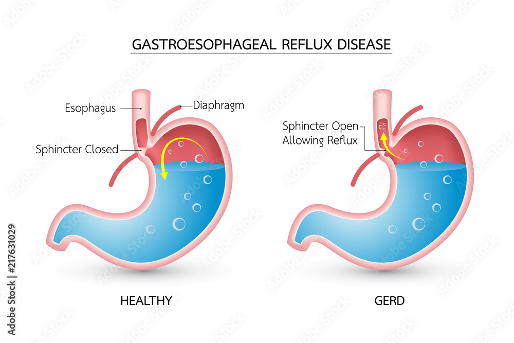 Gastroesophageal reflux disease (GERD). Acid reflux, heartburn and gerd ...