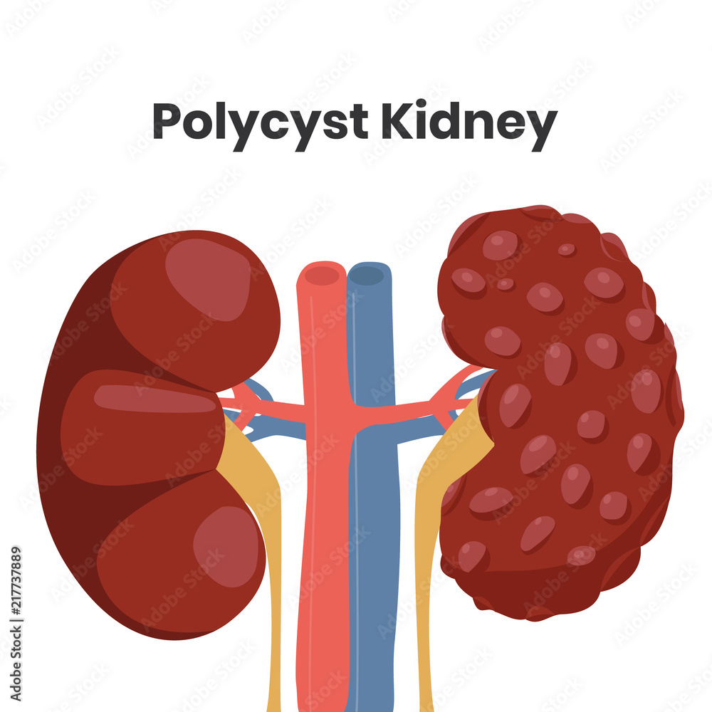 Vector illustration of the polycystic kidney disease, Stock Vector ...