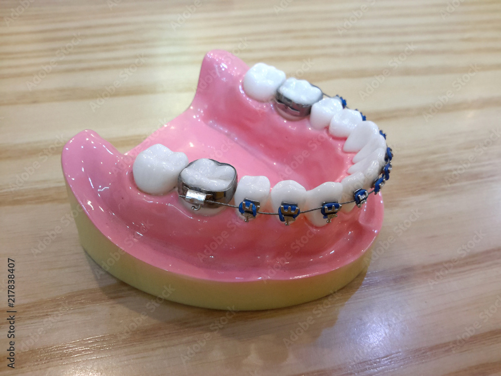 Orthodontic model of lower teeth with metal bracket ,mini screw and ...