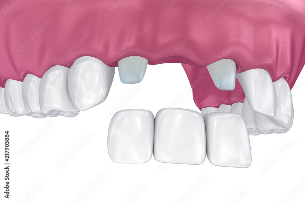 Tooth supported fixed bridge. Medically accurate 3D illustration Stock ...