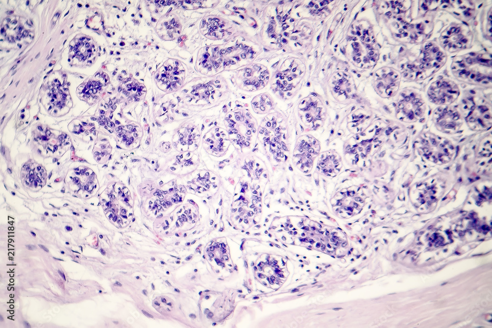 Hard breast cancer, light micrograph, photo under microscope Stock ...