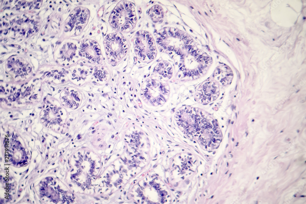 Hard breast cancer, light micrograph, photo under microscope Stock ...