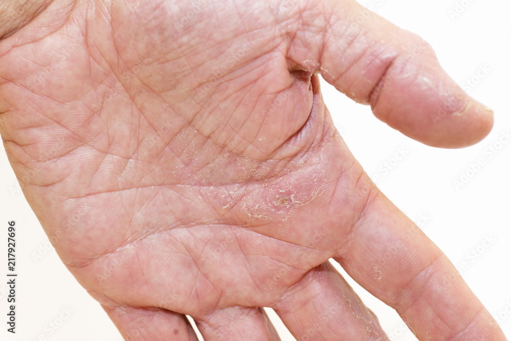 Neurodermitis, linke Handfläche, Detail Stock-Foto | Adobe Stock