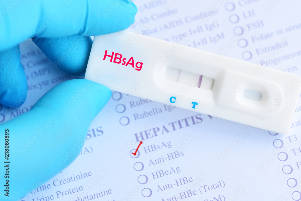 Hepatitis B virus positive test result by using rapid test cassette ...