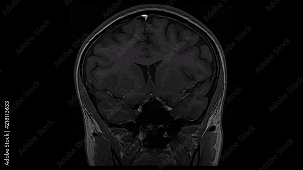 Computed medical tomography MRI upscaled scan of healthy young female ...