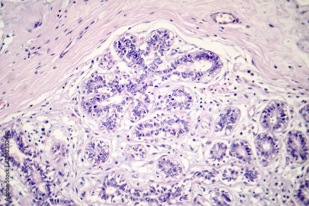 Hard breast cancer, light micrograph, photo under microscope Stock ...