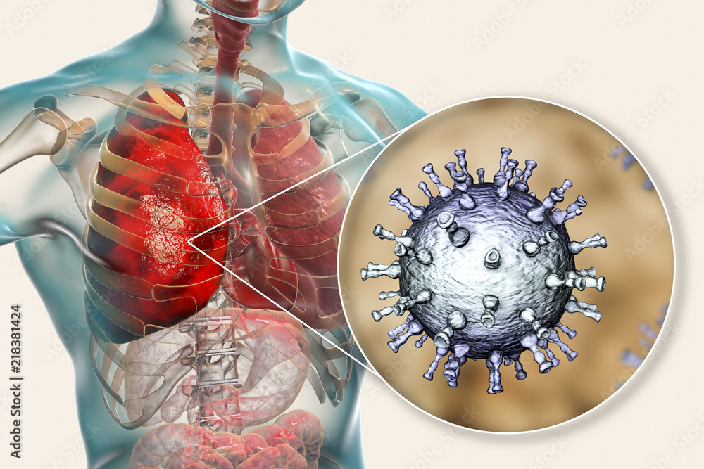 Varicella zoster virus pneumonia, chickenpox complication, 3D ...