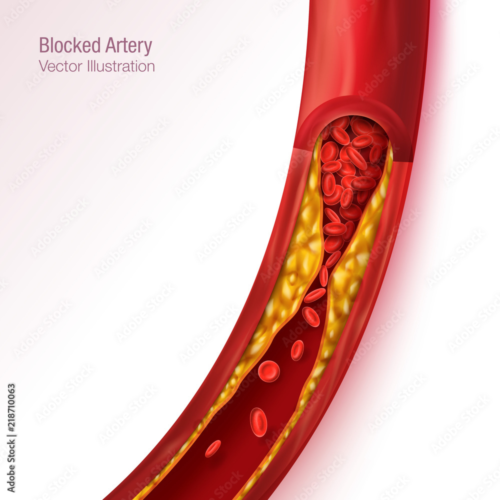 Blocked blood vessel - artery with cholesterol bulidup realistic vector ...