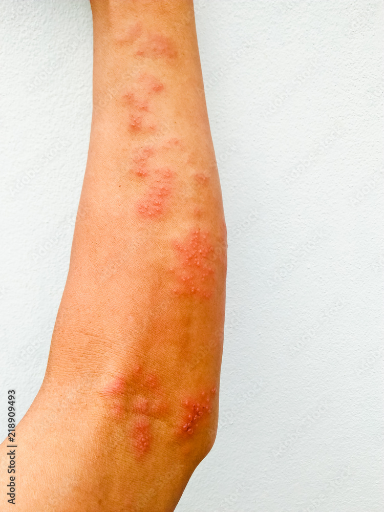 Herpes zoster occurs at the human arm. Stock Photo | Adobe Stock