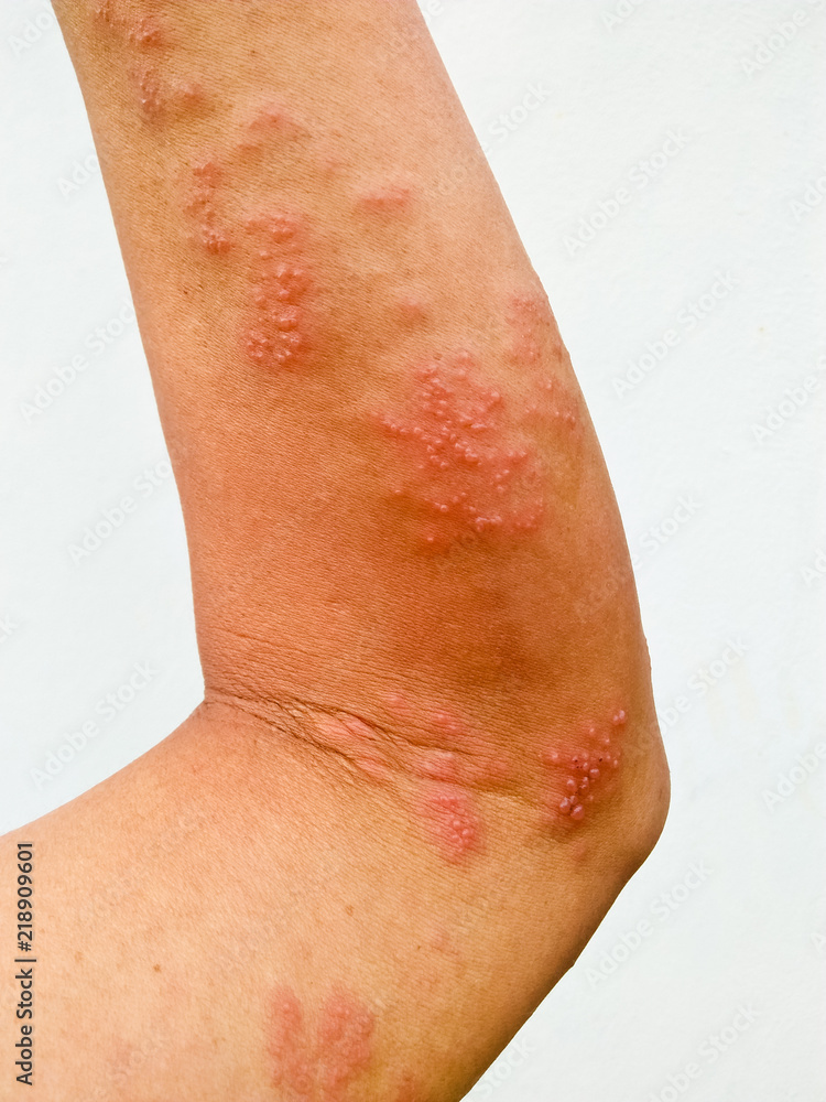 Herpes zoster occurs at the human arm. Stock Photo | Adobe Stock