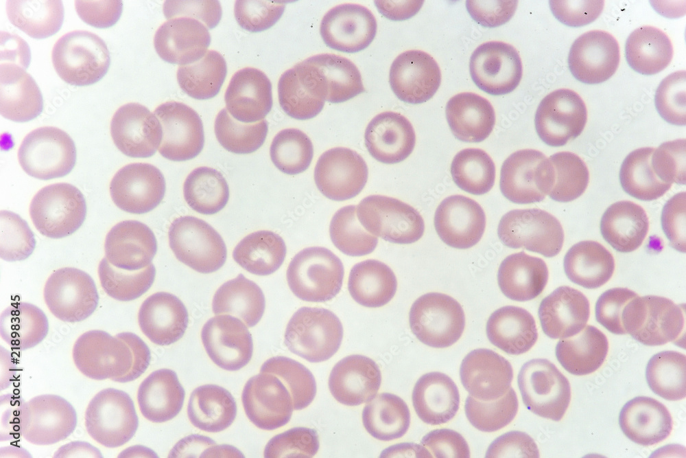 Target cells with abnormal red blood cells from anemia patient, analyze ...