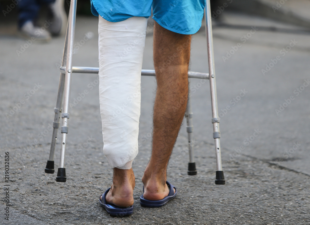 Details of the leg in a plaster cast Stock Photo | Adobe Stock