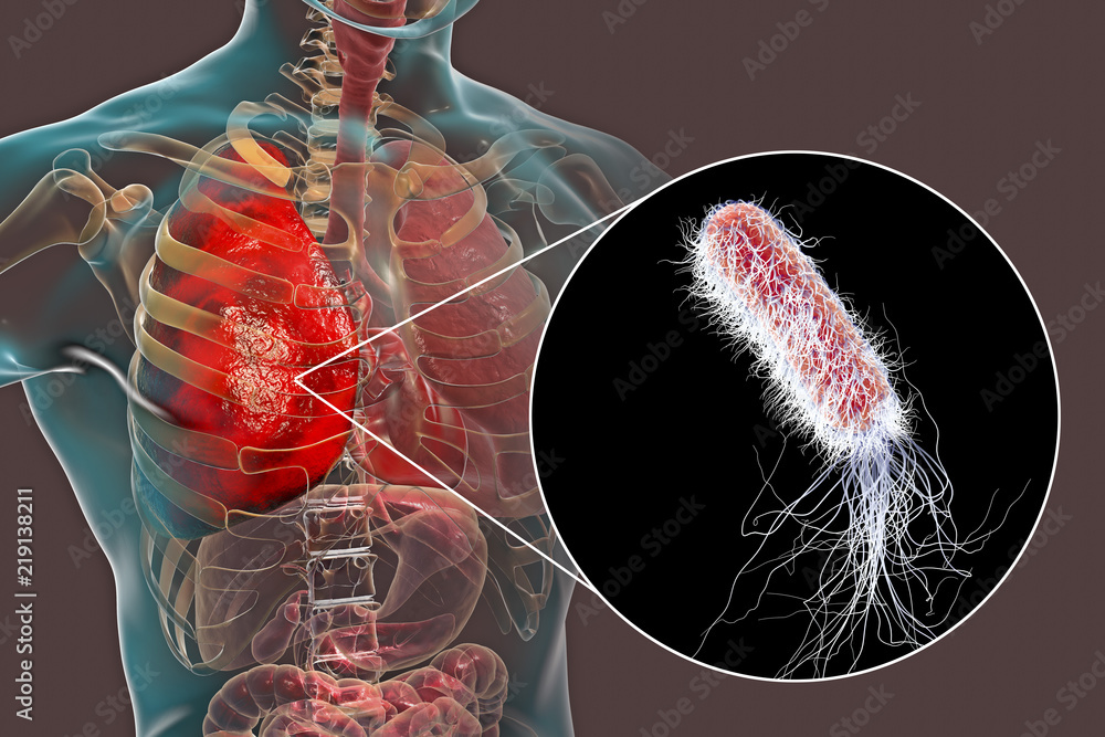 Pseudomonas Lung Infection Pseudomonas Lung Infection