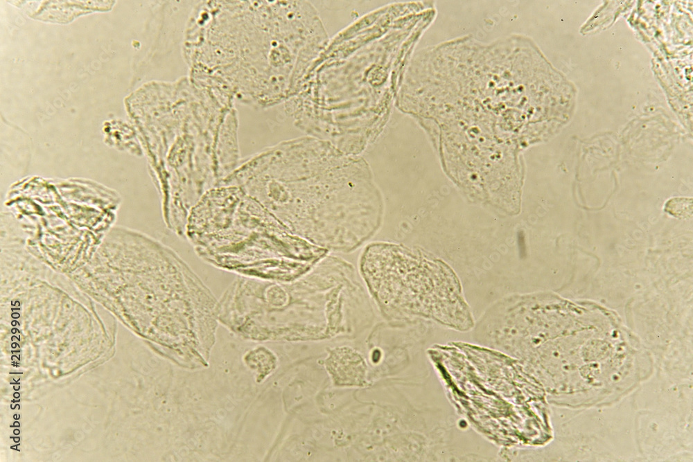 Urinary Tract Infection Microscopic Examination at Jonathan Baylee blog