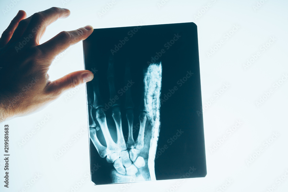 Traumatologist diagnoses and watches the healing process of a broken ...