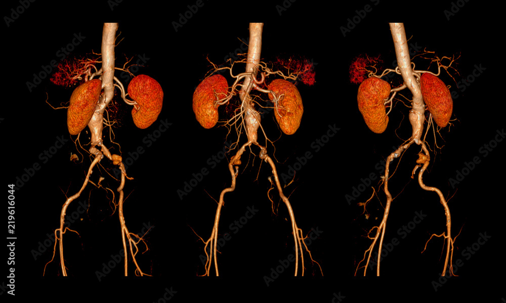CTA ABDOMINAL AORTA AND FEMORAL RUN OFF FINDINGS: infrarenal aortic ...