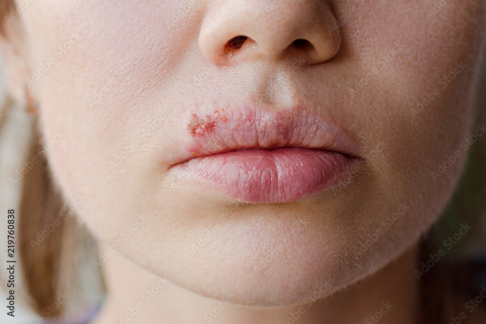 Part of a young woman's face with a virus herpes on lips Stock Photo ...