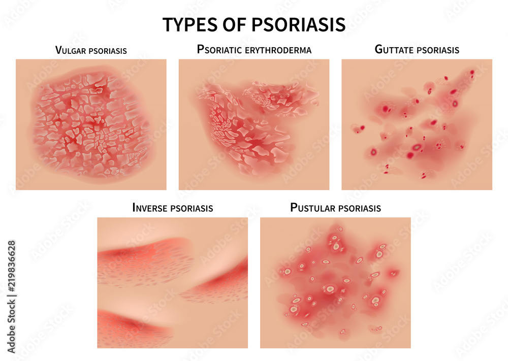 Psoriasis types. Skin hives, derma diseases. Closeup medical vector ...