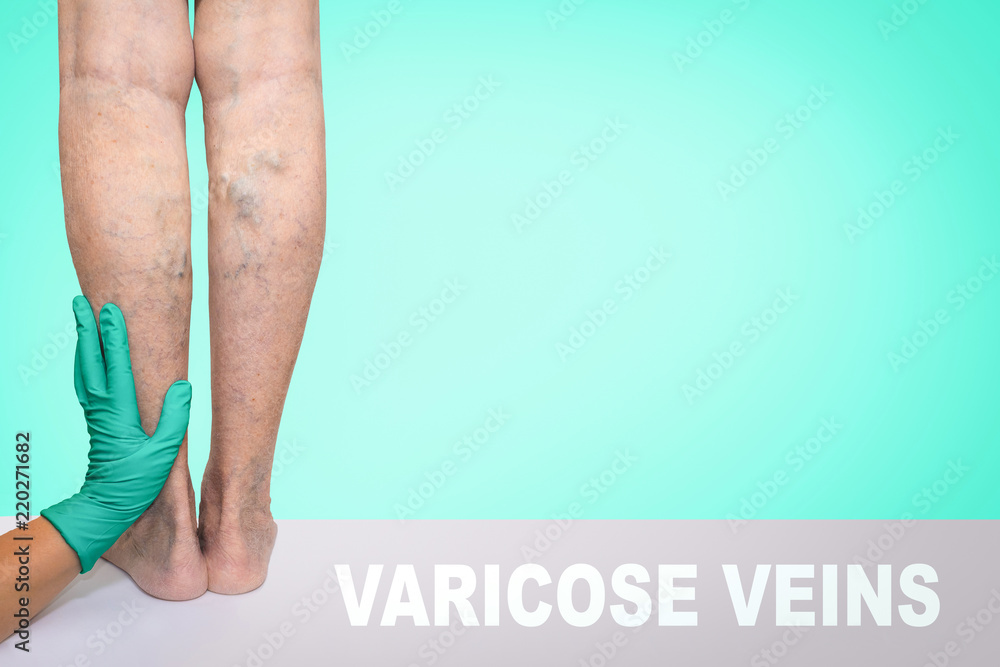 Lower limb vascular examination because suspect of venous insufficiency ...