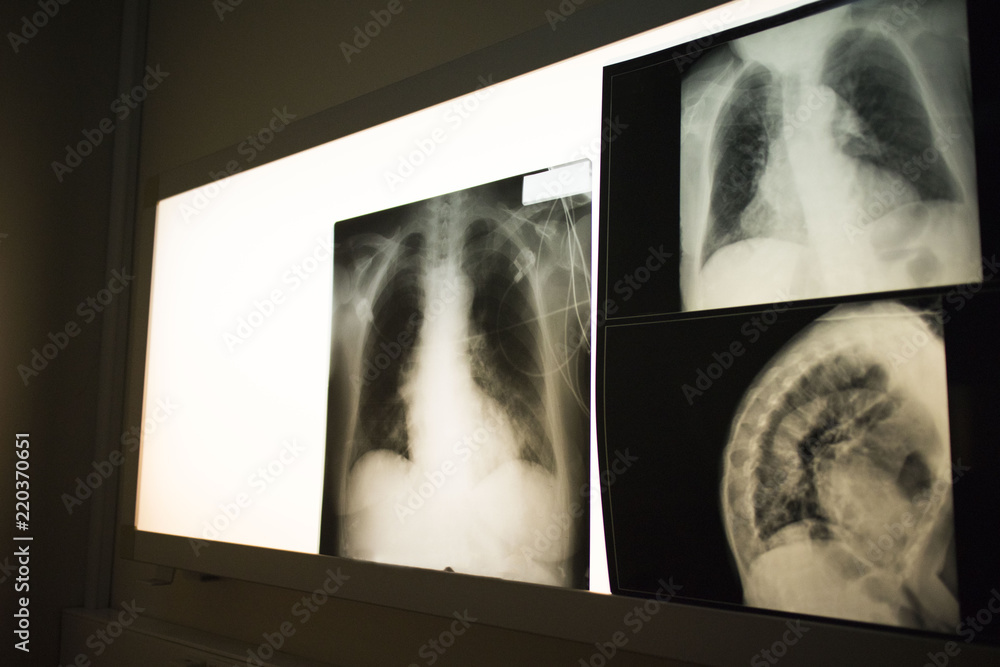 Foto de chest x-ray hanging on the monitor do Stock | Adobe Stock