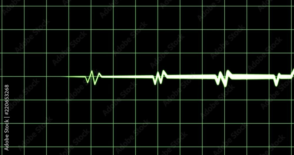 ECG, electrocardiogram showing a slow heart rate, vital signs data ...
