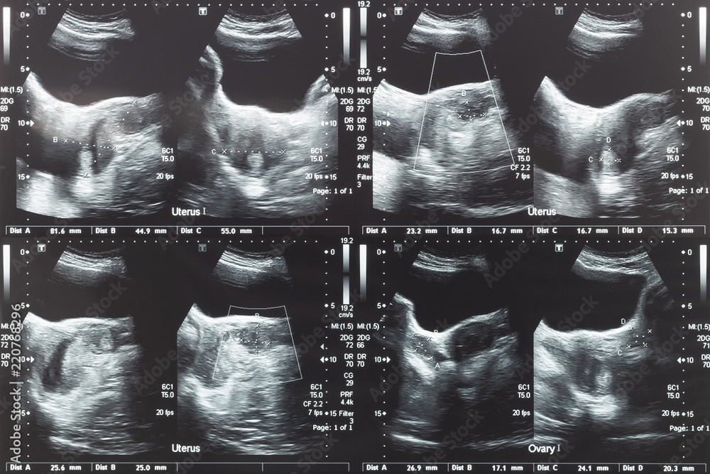 Ultrasound Image Of Lower Abdomen Ovary And Uterus With Tumor Or
