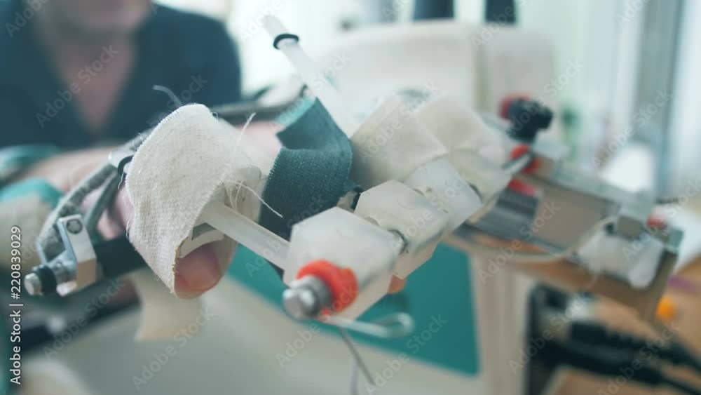 Fingers of a male patient are getting lowered and bent by a medical ...
