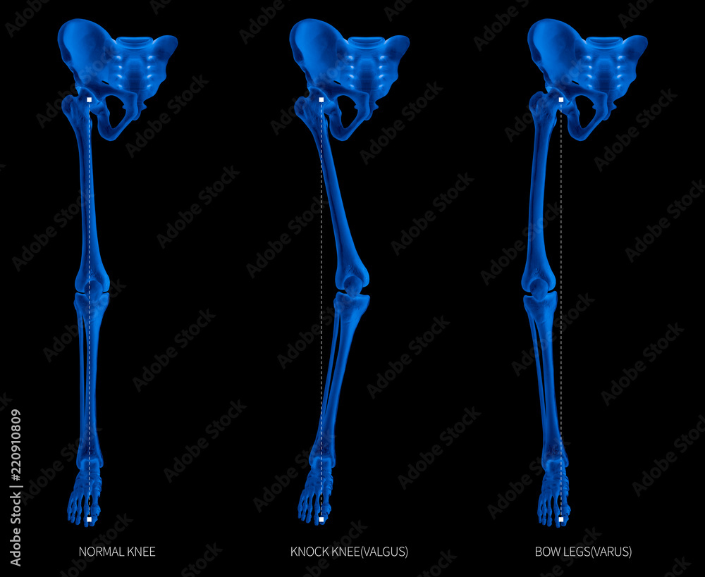 Alignment types of disease lower half limbs or leg bone problem- normal ...