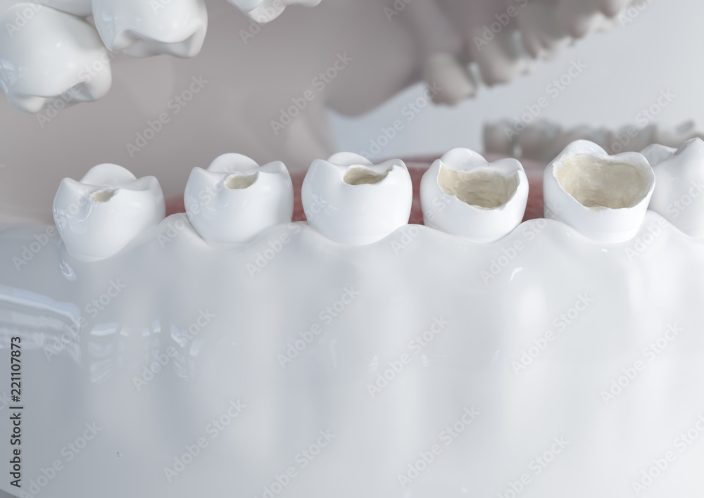 The stages of caries on the molar - 3D Rendering Stock Illustration ...