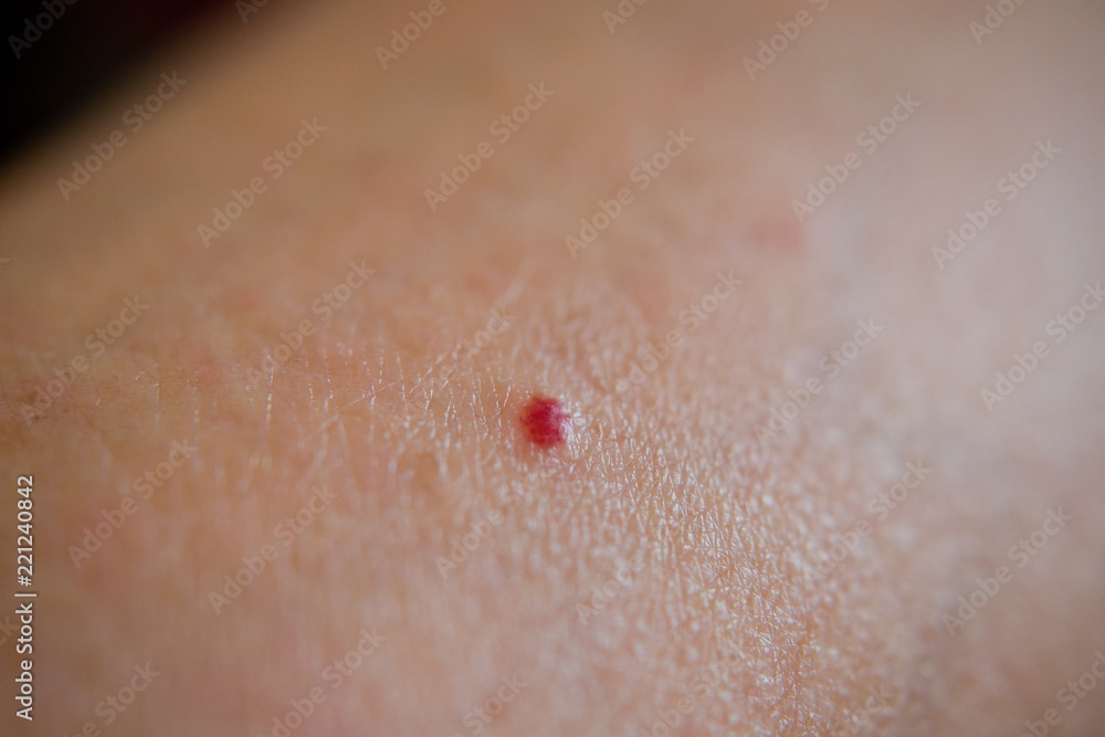 red moles on the skin Stock Photo | Adobe Stock
