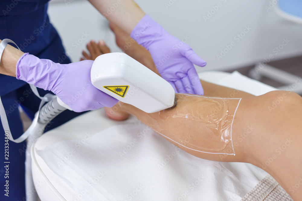 Epilation with a diode laser, hair removal with laser Stock Photo ...