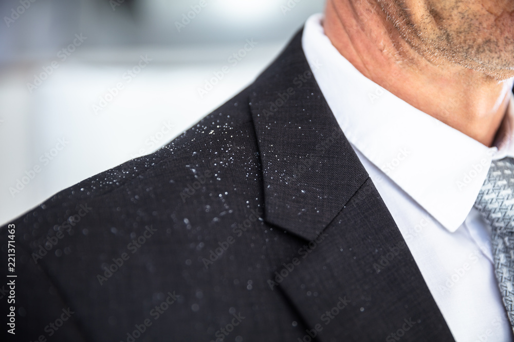 Dandruff Fallen On Businessperson's Shoulder Stock Photo | Adobe Stock
