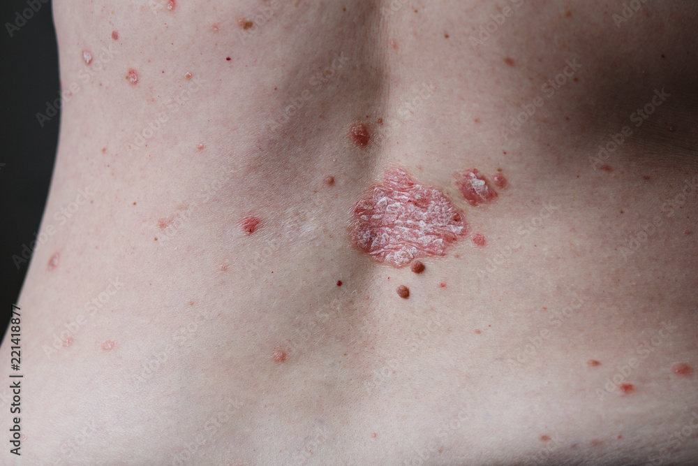 Eczema Atopic Dermatitis Symptom Skin Texture Close Up Skin With Red