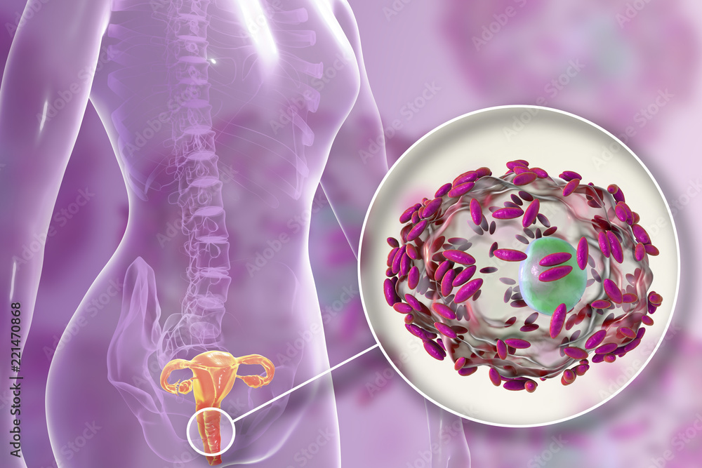 ภาพประกอบสต็อก Bacterial vaginosis. Vaginal secretions contain ...