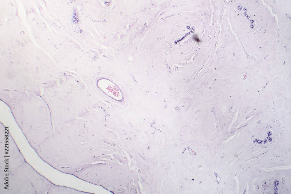 Fibroadenoma, a benign brest tumor, light micrograph, photo under ...