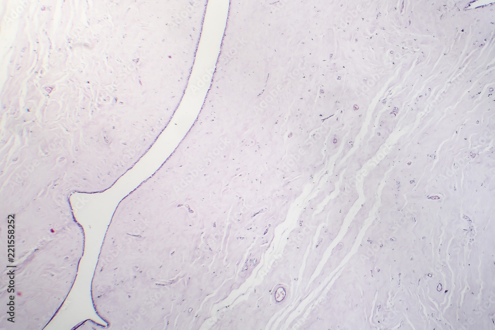 Fibroadenoma, a benign brest tumor, light micrograph, photo under ...