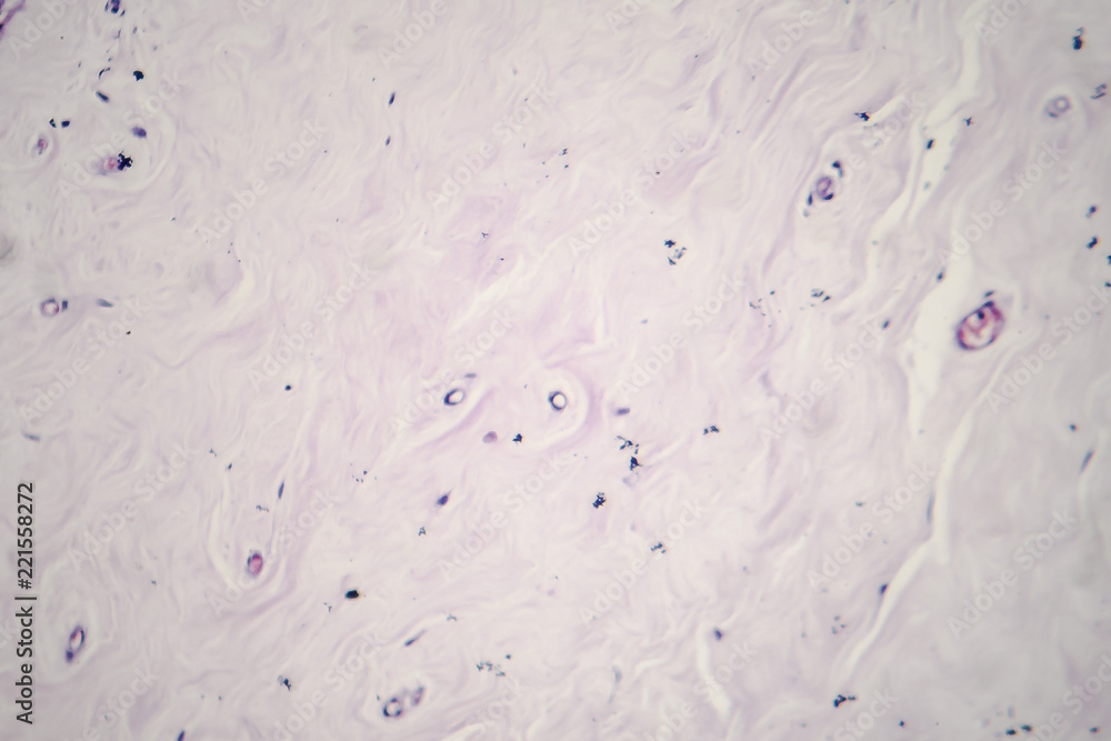 Fibroadenoma, a benign brest tumor, light micrograph, photo under ...