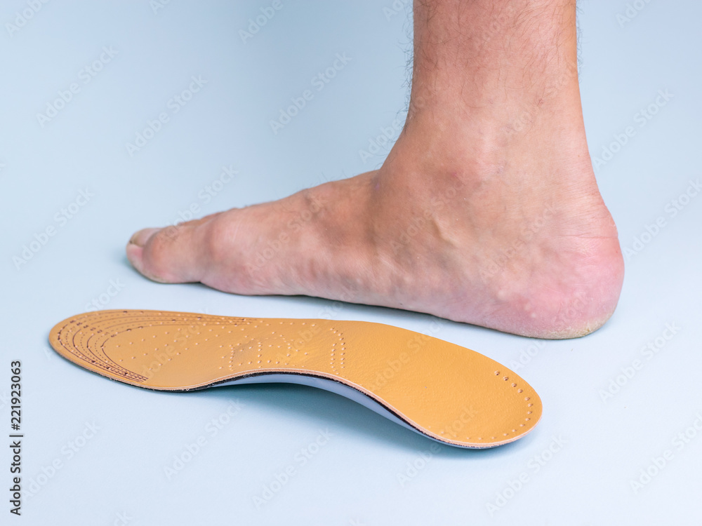 Orthopedic insole on the right leg and the leg of a man with signs of ...